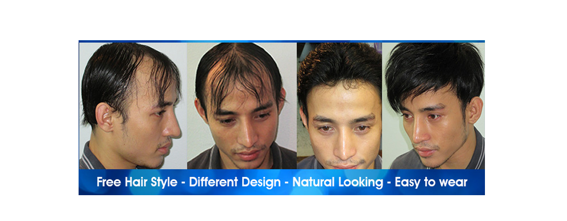 Custom Hair Replacement Systems and Toupees for Men and Women with Hair ...